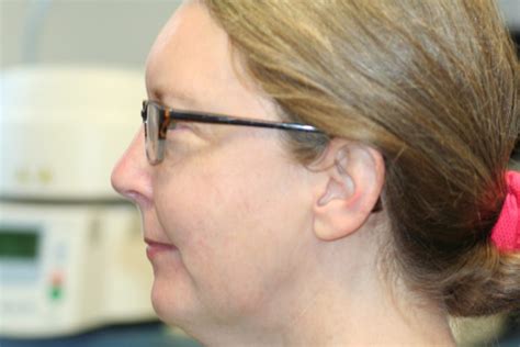 Before And After Invisalign Class Ii Div 2 Mcfarlane Dental