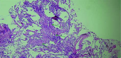 Lung Parenchyma And Interstitium