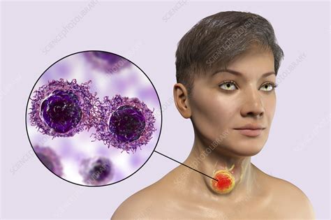 Woman With Thyroid Cancer Illustration Stock Image F0386020