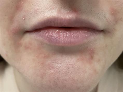 Sudden Itchy Rash With Small Pimples Developed After Wearing A Face