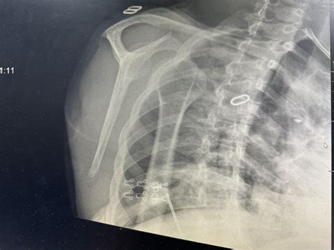 Two Different Cases Of Spontaneous Displacement With Trauma Rradiology