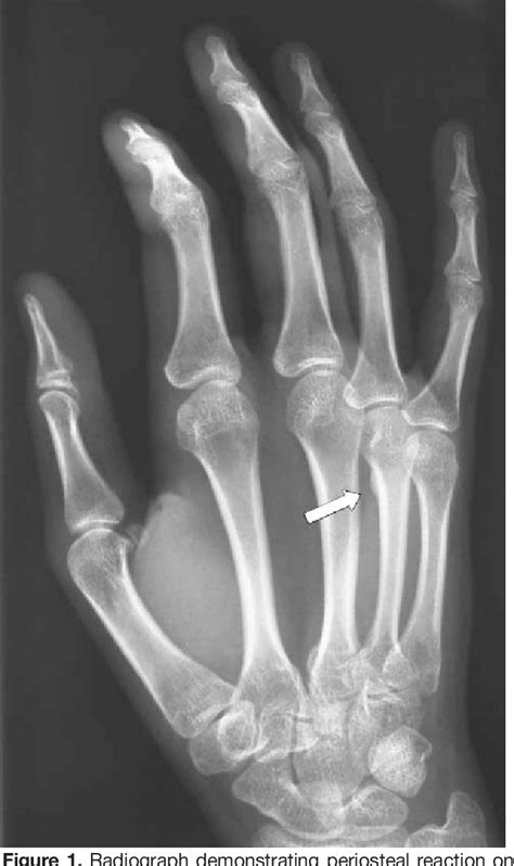 Figure 1 From Metacarpal Stress Fracture In An Intercollegiate Rower Semantic Scholar