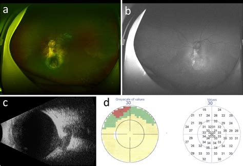Fundus Faf B Scan Ultrasonography And Perimetric Examination Of The Download Scientific