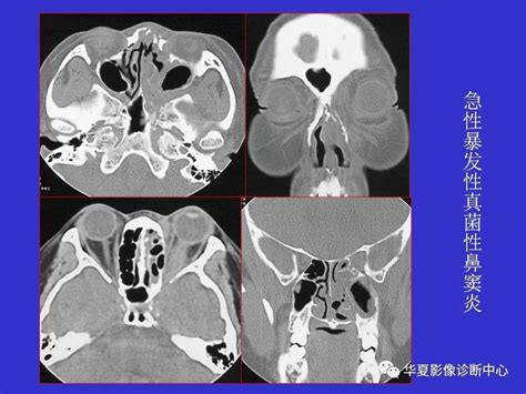 带你了解 真菌性鼻窦炎 MedSci cn
