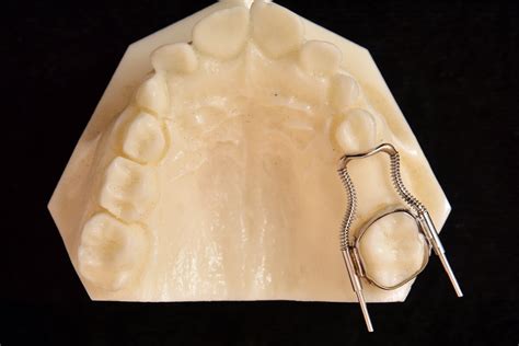 Space Regainer Maintainer Parklund Orthodontic Lab