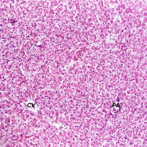 Focal Coagulative Necrosis Of Hepatocytes Infiltrated With Mononuclear