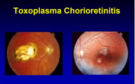 Congenital Toxoplasmosis Chorioretinitis