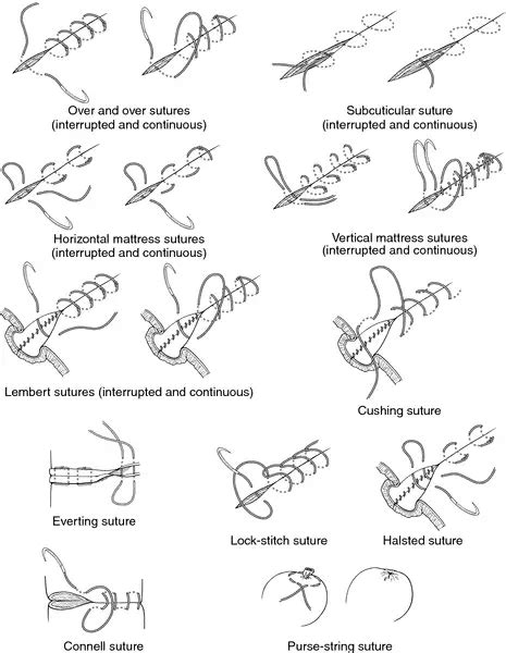 Continuous Suture Definition Of Continuous Suture By Medical Dictionary