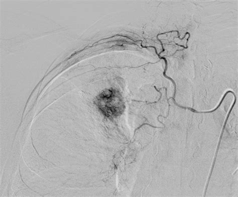 Bronchial Arterial Embolisation For Massive Haemoptysis In Cavitary