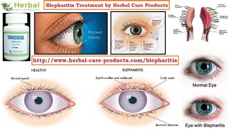 6 Natural Treatments For Blepharitis Herbal Care Products Blog