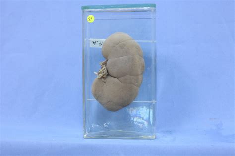 泌尿系统疾病