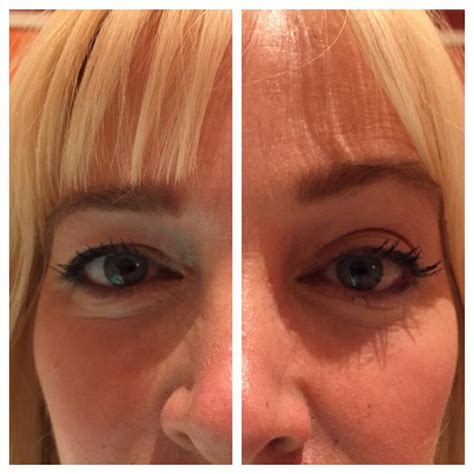 Hooded Eyelids Causes Of Hooded Eyes Contours Rx