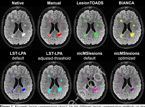 Figure 1 From Comparing Lesion Segmentation Methods In Multiple Sclerosis Input From One