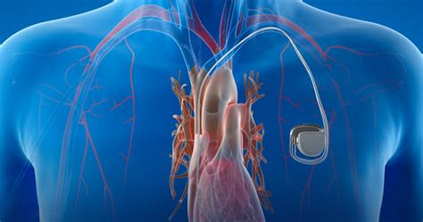 Pacemakers And Defibrillators Heart And Vascular