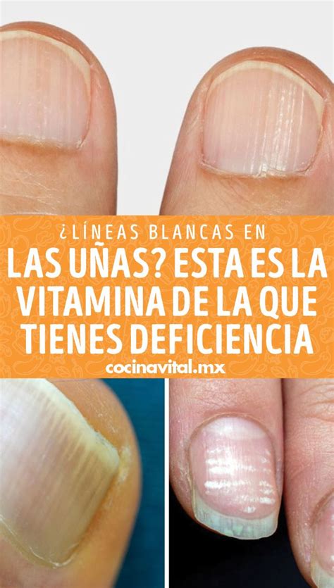 Por qué me salen líneas en las uñas y cómo eliminarlas Pueden