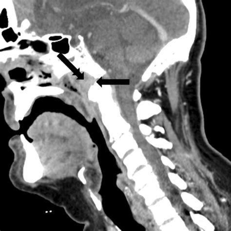 Sagittal Ct Scan Showing Partial Clival Erosion Simple Arrow With