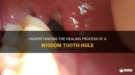 Understanding The Healing Process Of A Wisdom Tooth Hole Medshun