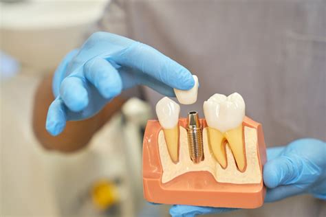 The Latest Advances In Dental Implants Explained Jj Smiles Dental