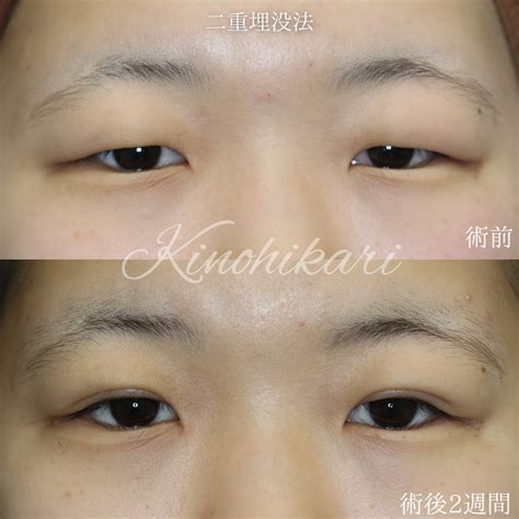 二重埋没法 術前・術後2週間 二重埋没法の症例写真・画像 樹のひかり 形成外科・皮ふ科 奈良本院 Cs77688《美容医療の口コミ広場》