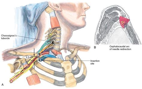 Infraclavicular Block Clinical Tree