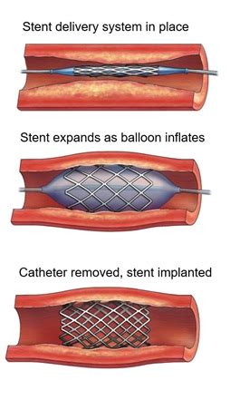 Device Tutorial Stents