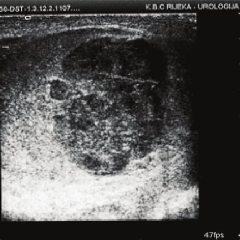 Immunofluorescence Staining Detected Deposits Of Fibrin In Testicular