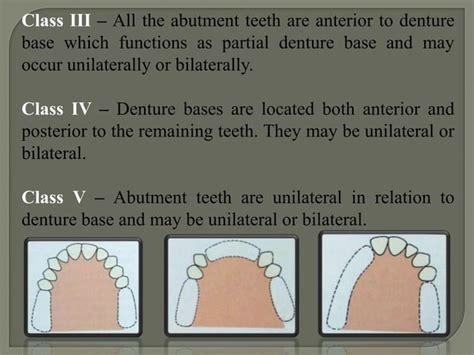 Classification Of Rpd