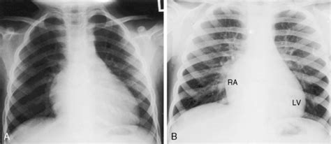 Isolated Congenital Complete Heart Block Thoracic Key
