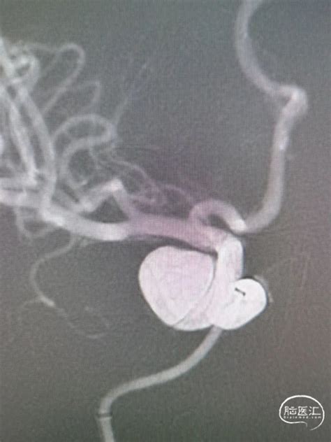 Time To Evolve 超越之旅 新一代密网支架surpass Evolve结合弹簧圈治疗眼段大动脉瘤 脑医汇