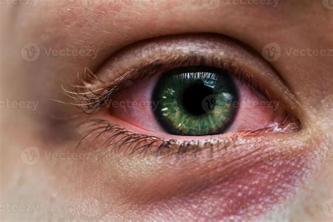 Infected Female Eye With A Green Iris And Subconjunctival Hemorrhage