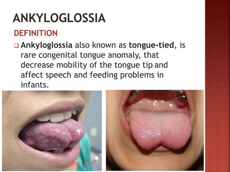 Tongue Disorderspptx