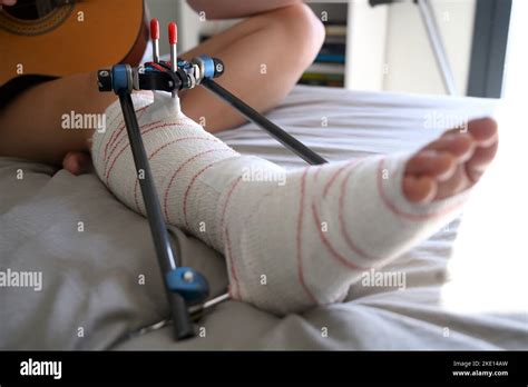Woman With External Fixation Right Tibial Fracture Stock Photo Alamy