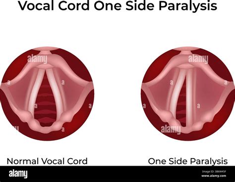 Vocal Cord Paralysis One Side Design Vector Illustration Stock Vector
