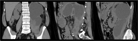 Gastrointestinal Large Psoas Muscle Collection From Communication With