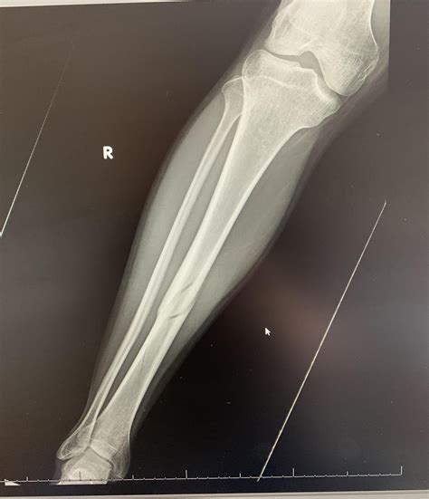 Tibia Spiral Fracture From Hopping Out Of Bed With My Leg Asleep 26