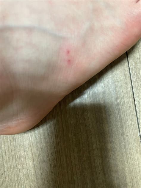 물린자국 이거 뭘까요 지식in
