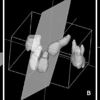 Angular Measurements At Reconstructed Image From CT Scanning A Download Scientific Diagram