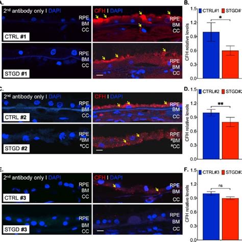 Complement Factor H Levels Are Reduced In The RPE Cells Of Stargardt Download Scientific