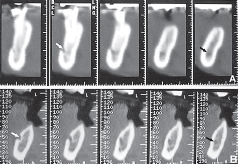 A Single Slice Ct Cross Section Of The Mandible B Multislice Ct Download Scientific Diagram