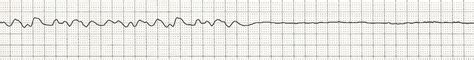 Asystole Ecg Book