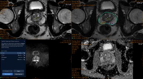 Mdprostate Sectra Amplifier Marketplace