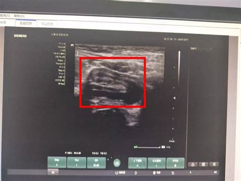 【万荣县中医院重磅医讯】我院儿童健康管理中心成功实施首例肠套叠气液灌肠保守治疗复位术