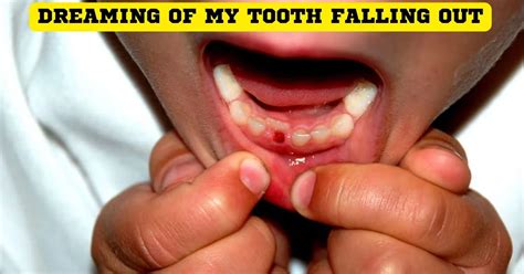 Why Am I Dreaming Of My Tooth Falling Out