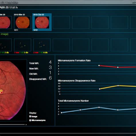 Pdf Microaneurysm Turnover In The Macula Is A Biomarker For