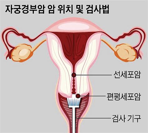 자궁경부암 예방접종