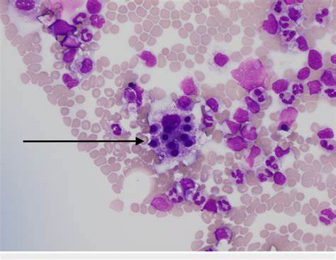 Pathology Of Bone Marrow Biopsy Revealing Hemophagocytosis Of Multiple
