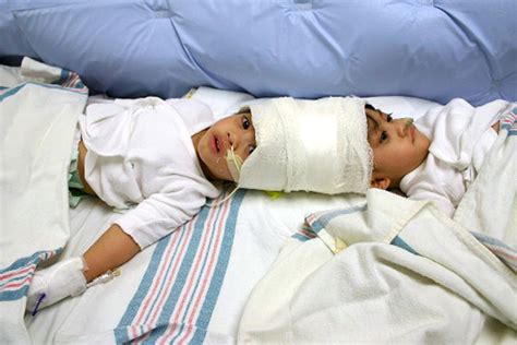 Twins Conjoined At Head Thriving 10 Years After Miracle Surgery