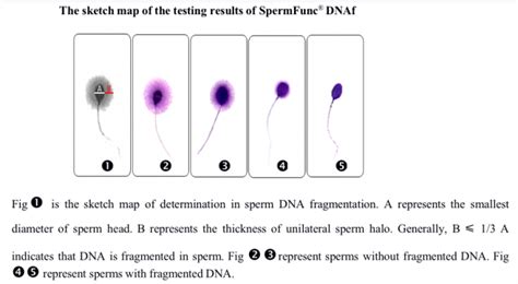 Economical Sperm Dna Fragmentation Test Kit For Dna Fragmentation Level Determination Sperm