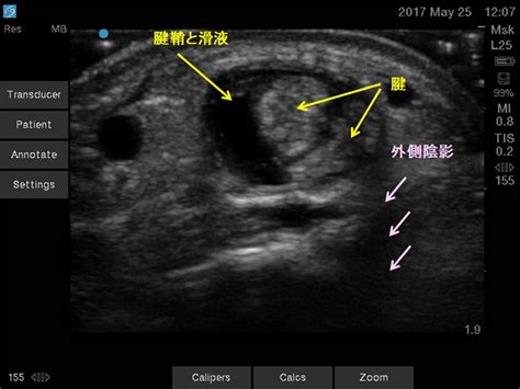 超音波診断コラム装置原理から臨床活用法 超音波画像のアーチファクトを楽しく学ぼう 富士フイルム 日本