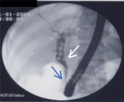 Magnetic Resonance Imaging Scan Of Pancreas Showing A Heterogeneously